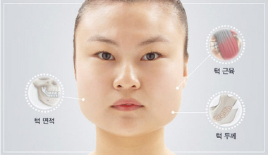 얼굴 작아지는 법 사각턱 수술, 뼈 두께와 근육까지 고려해야