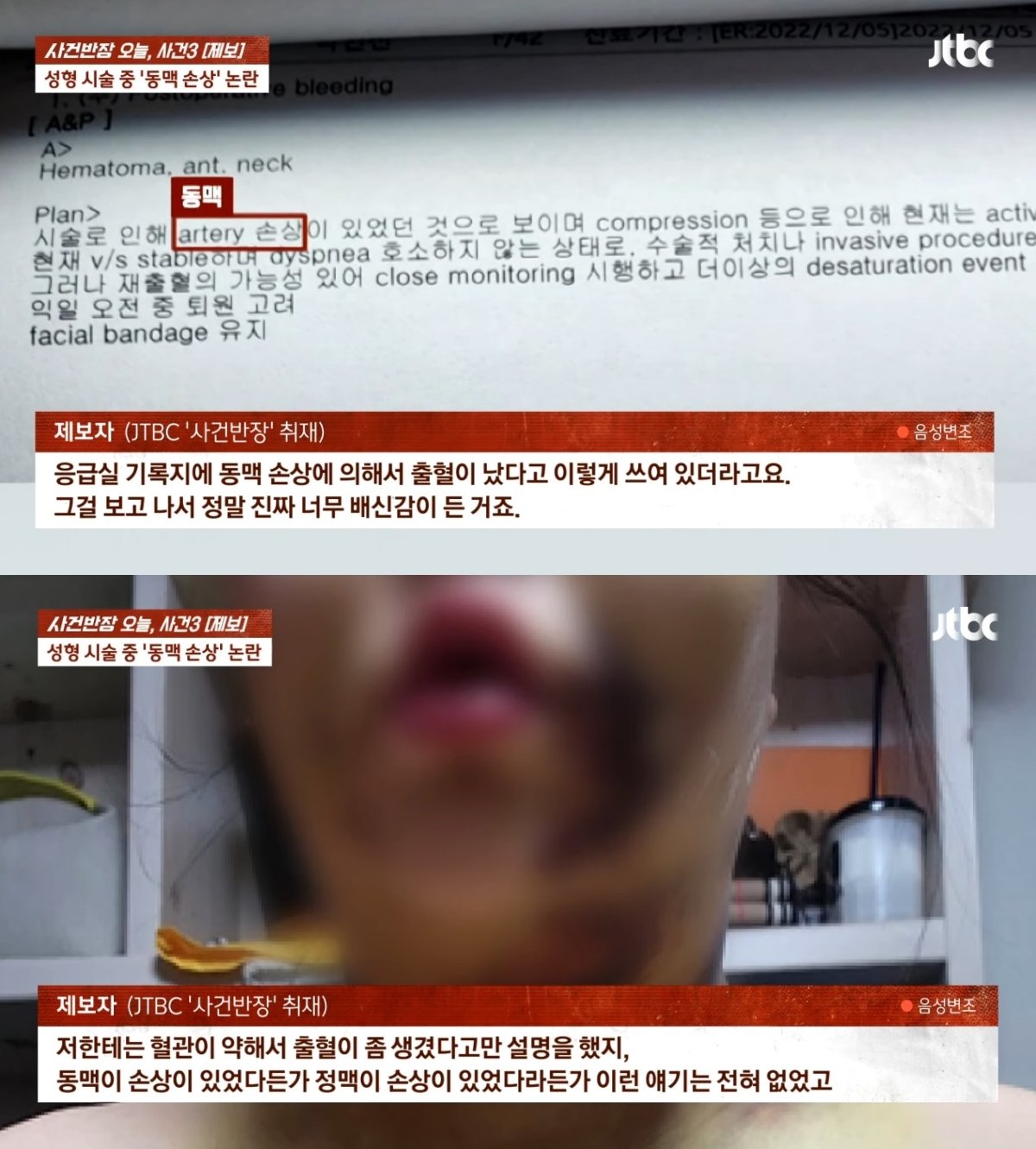 강남 성형외과서 지방흡입술 하다 턱 뚫렸다…진료기록에 '동맥 손상 출혈' - 뉴스1